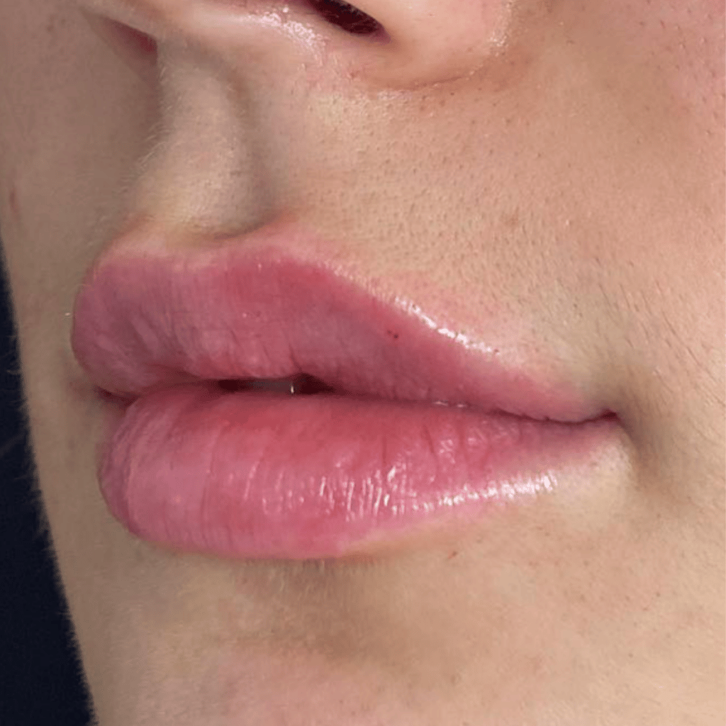 Is It Normal To Have Lumps After Lip Filler? | Lip Filler Side Effects