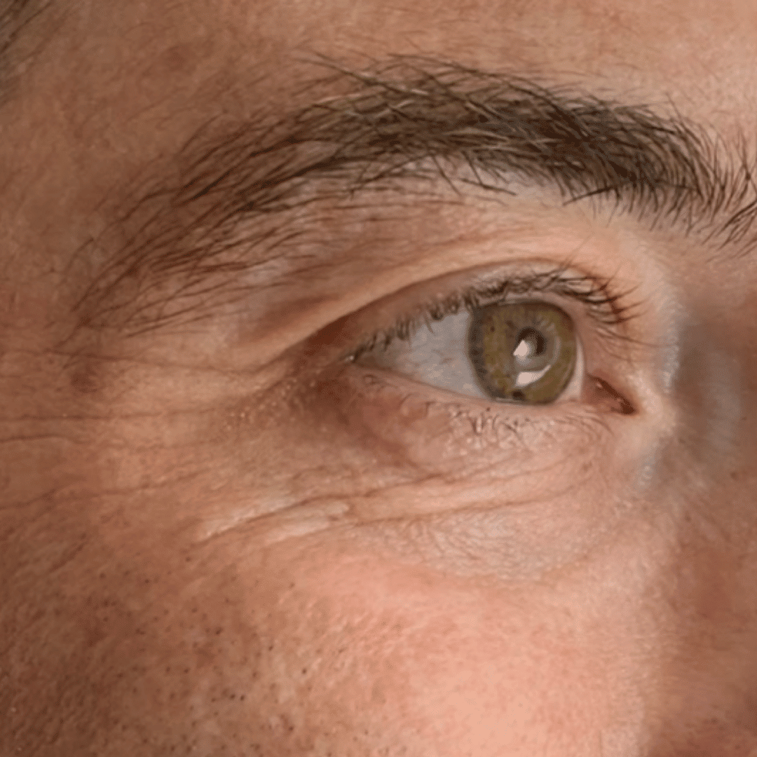 Mens Tear Trough Treatment London - VIVA Skin Clinics