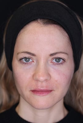 3d Facial Treatment | 3D Face Refresh | VIVA Skin Clinics