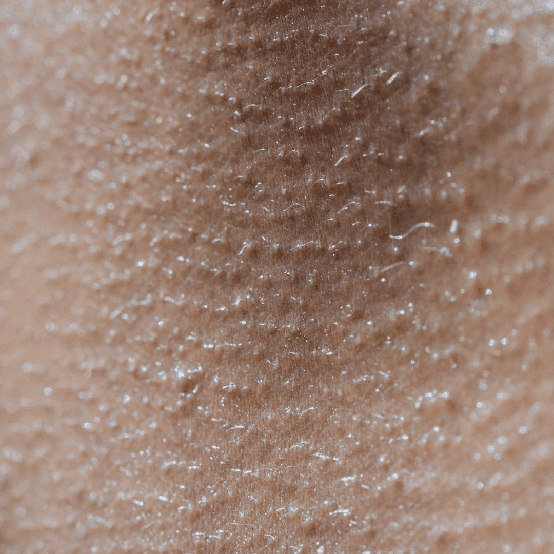 Hyperhidrosis - VIVA Skin Clinics