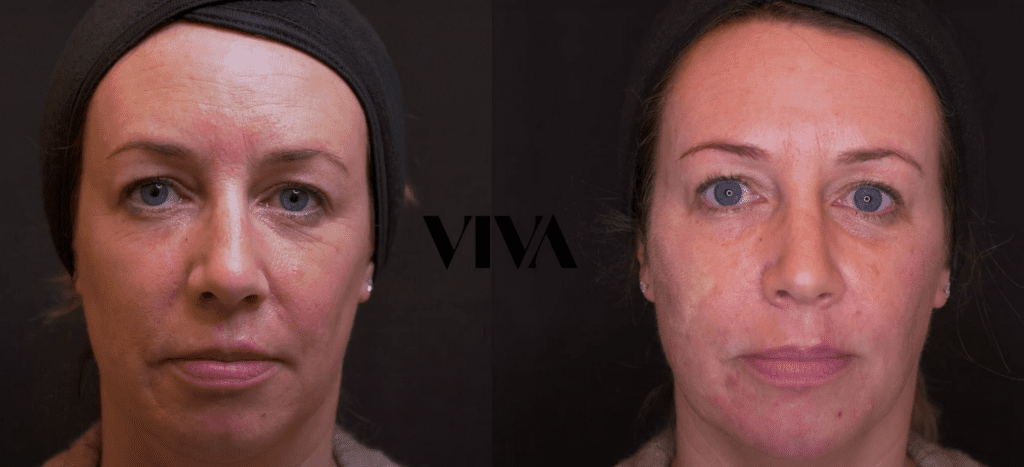 What Are Full Face Fillers? - VIVA Skin Clinics