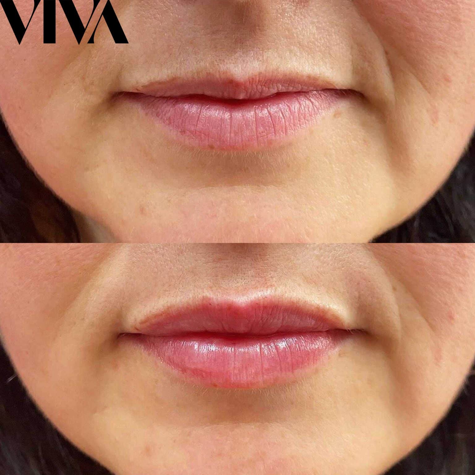 Can Lip Fillers Look Lumpy? - VIVA Skin Clinics