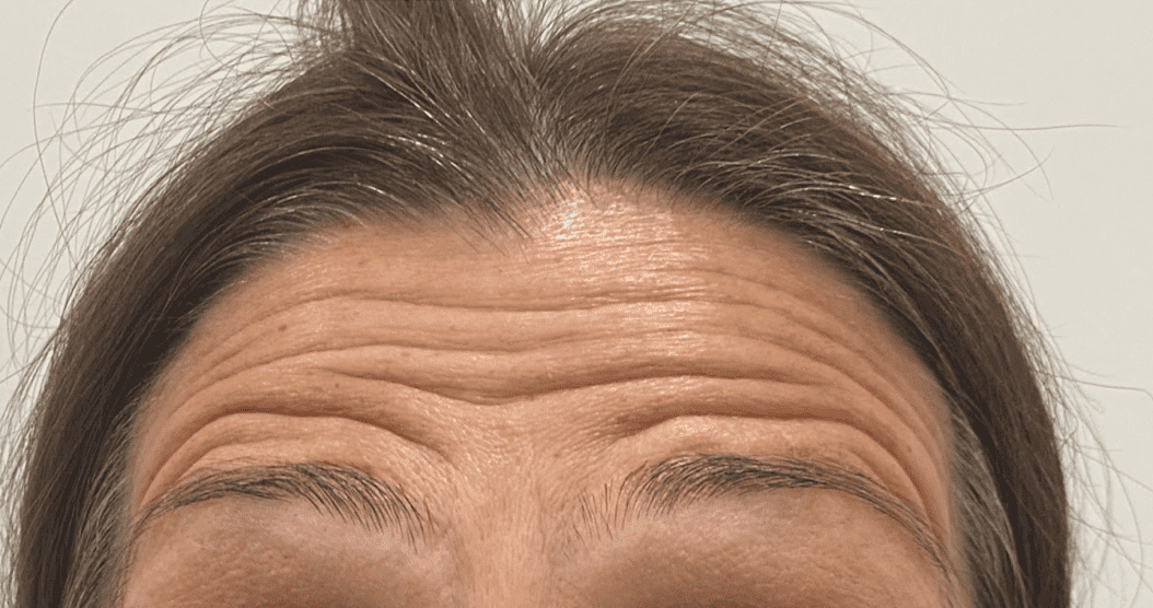 Best Botox Injections London | VIVA Skin Clinics