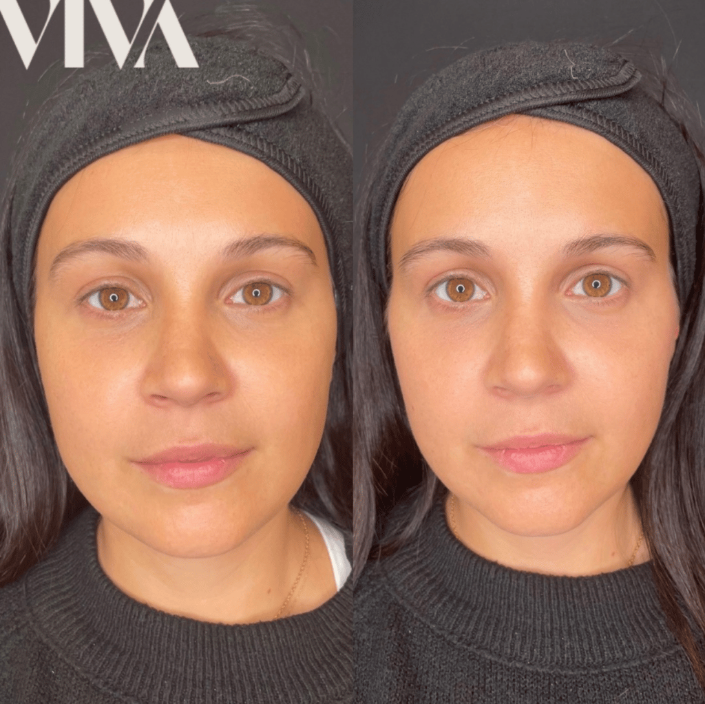 How Cheek Fillers Can Lift Jowls & Your Lower Face | Cheek Fillers