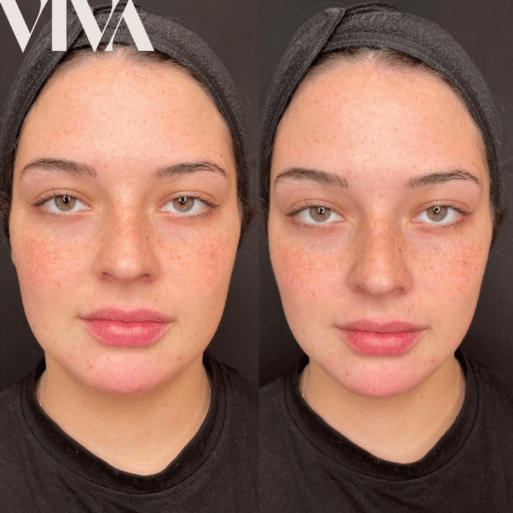 What is Facial Contouring? | VIVA Skin Clinics | Blog