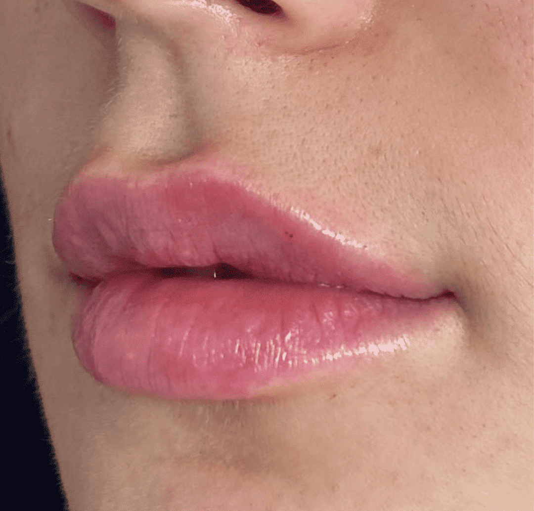 Why Is My Lip Line Swollen Lips Infoupdate Why Is My Lip Line Swollen Lips Infoupdate