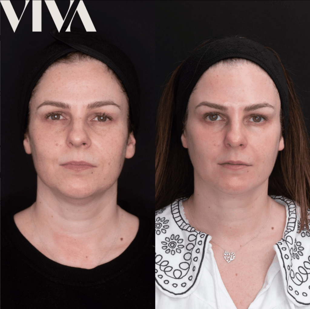 Before and Afters - VIVA Skin Clinics