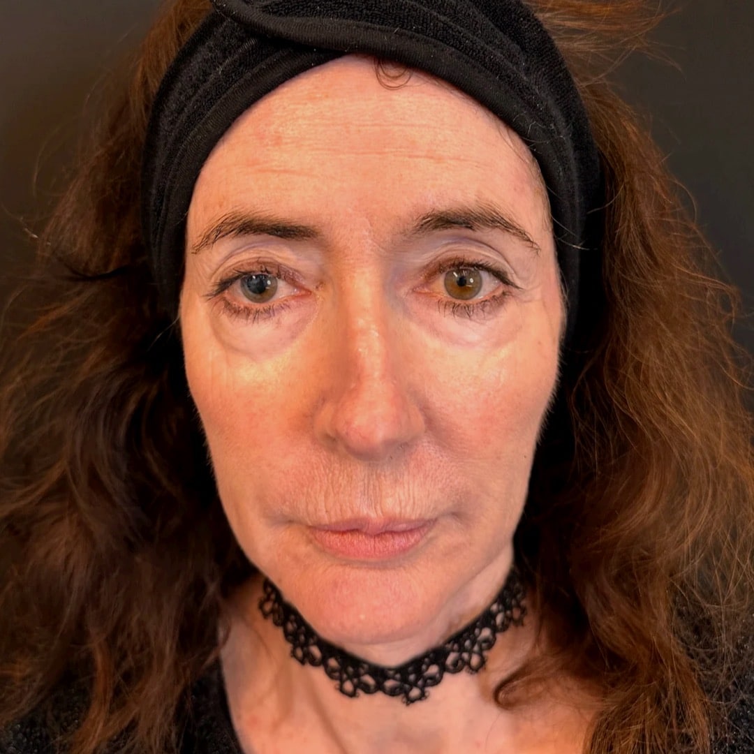 What are Skin Boosters? - Free Guide for Skin Boosters