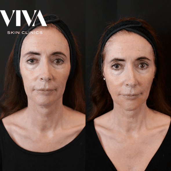 What are Skin Boosters? A Complete Guide to Glowing Skin