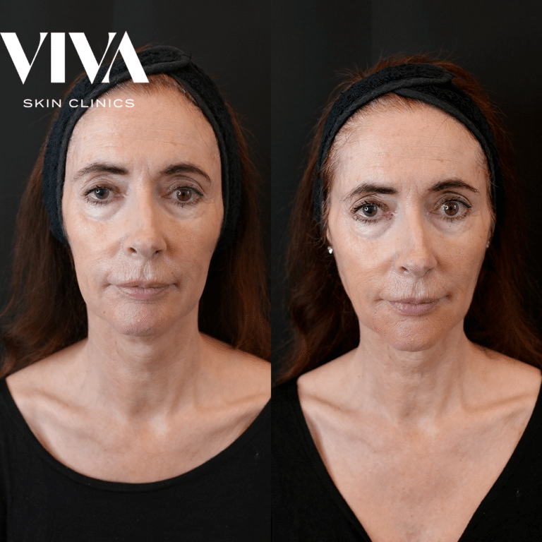 What are Skin Boosters? A Complete Guide to Glowing Skin