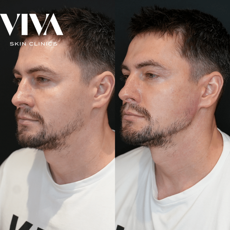 Men's Cheek Filler - Men's Cheekbone Filler from £375